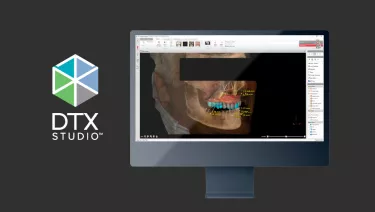All-on-4® digital workflow | Full-arch rehabilitation